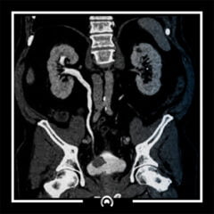 TOMOGRAFÍA COMPUTADA DE VIAS URINARIAS CON CONTRASTE – Nortac