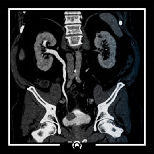 TOMOGRAFÍA COMPUTADA DE VIAS URINARIAS CON CONTRASTE – Nortac
